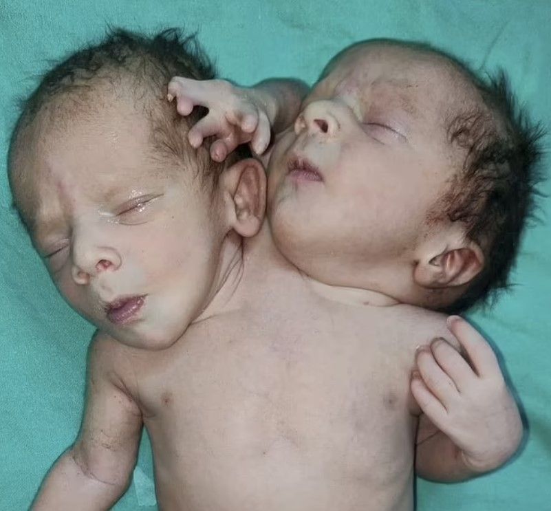 Indian Baby With Two Heads