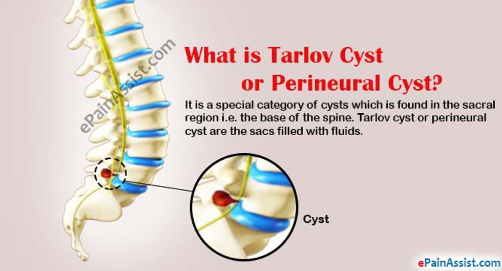 Tarlov Cyst Disease: Time To End The Silence And Spread Awareness!