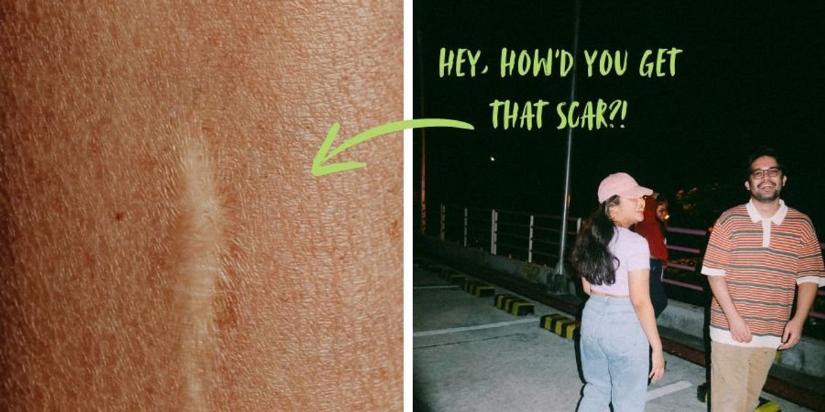 Gen X share unbelievably wild tales on how they got their scars - Upworthy