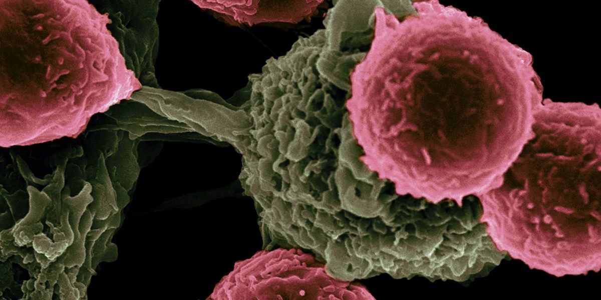 Rice researchers report promising human trial for implantable cancer ...