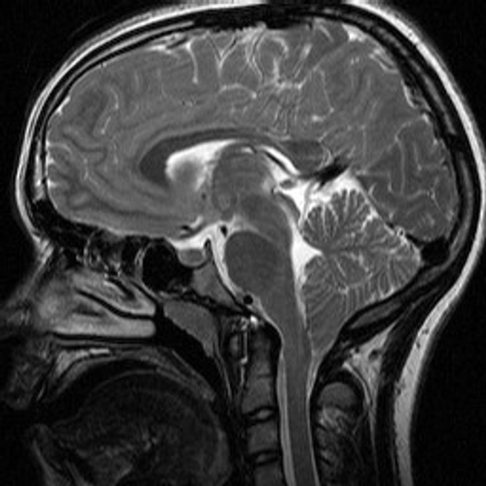 What is Arnold-Chiari Malformation?