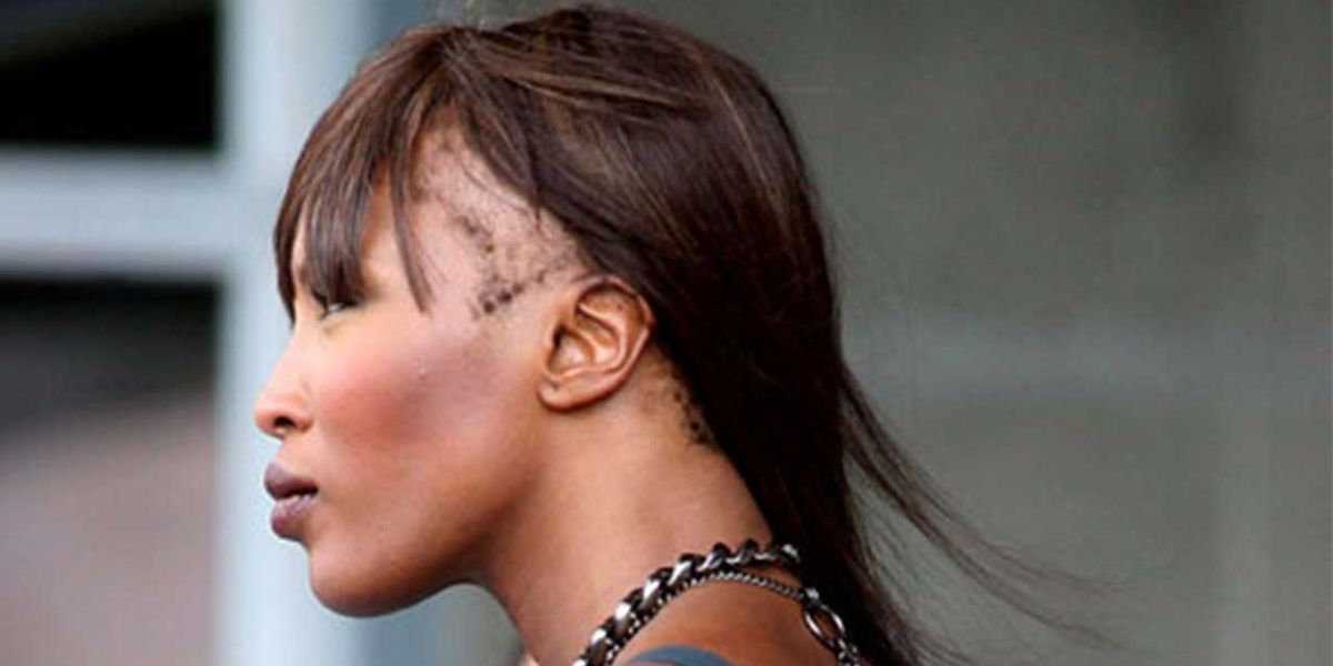 What You Need to Know About Alopecia - xoNecole: Lifestyle, Culture ...