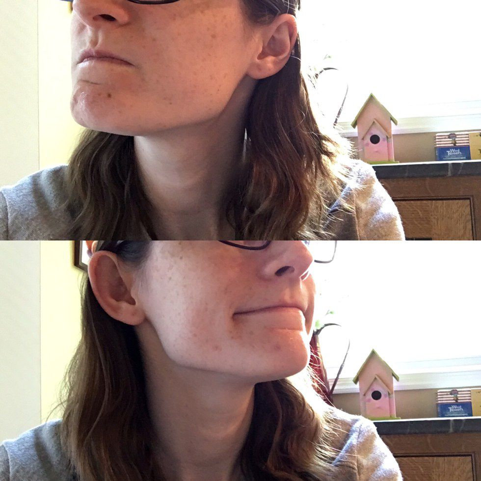 Living With Stahl’s Ear