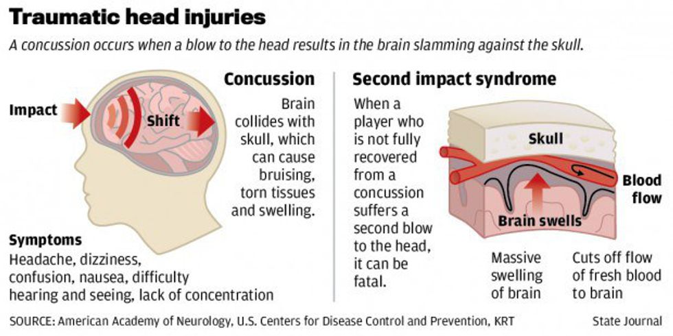 Concussions in Hockey