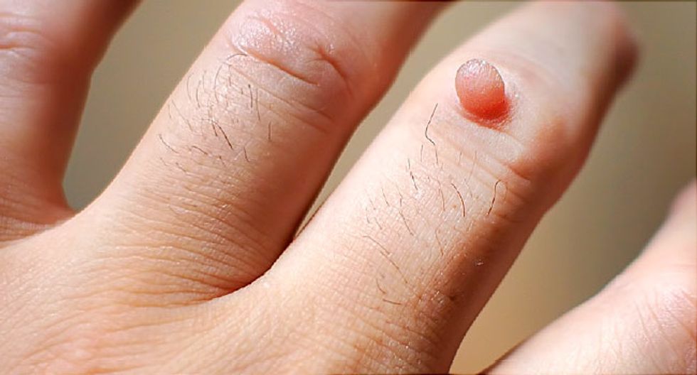 Common Skin Wart and Its Treatment