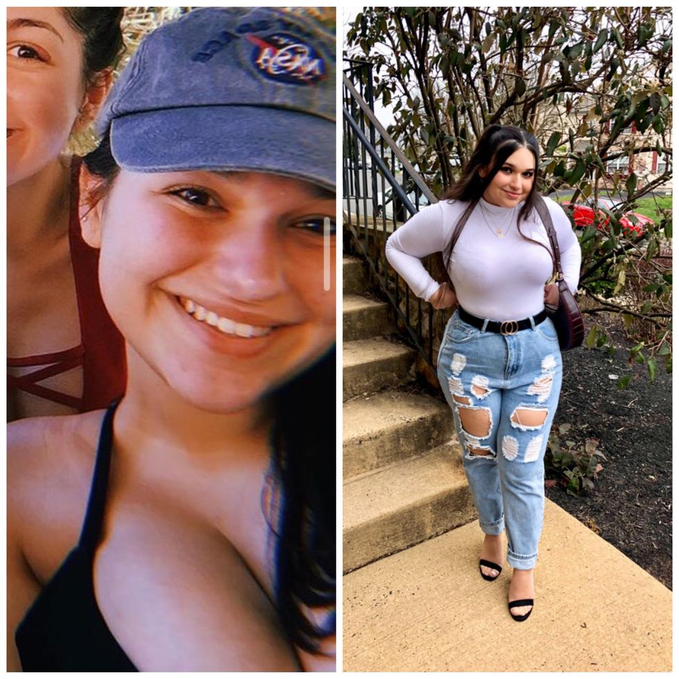 Breast Reduction Reality Is It Worth It